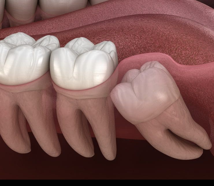 Common wisdom tooth problem and how to deal with them - Family Dental Care