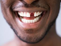 3 Cheapest Options to Replace a Missing Tooth - Family Dental Care